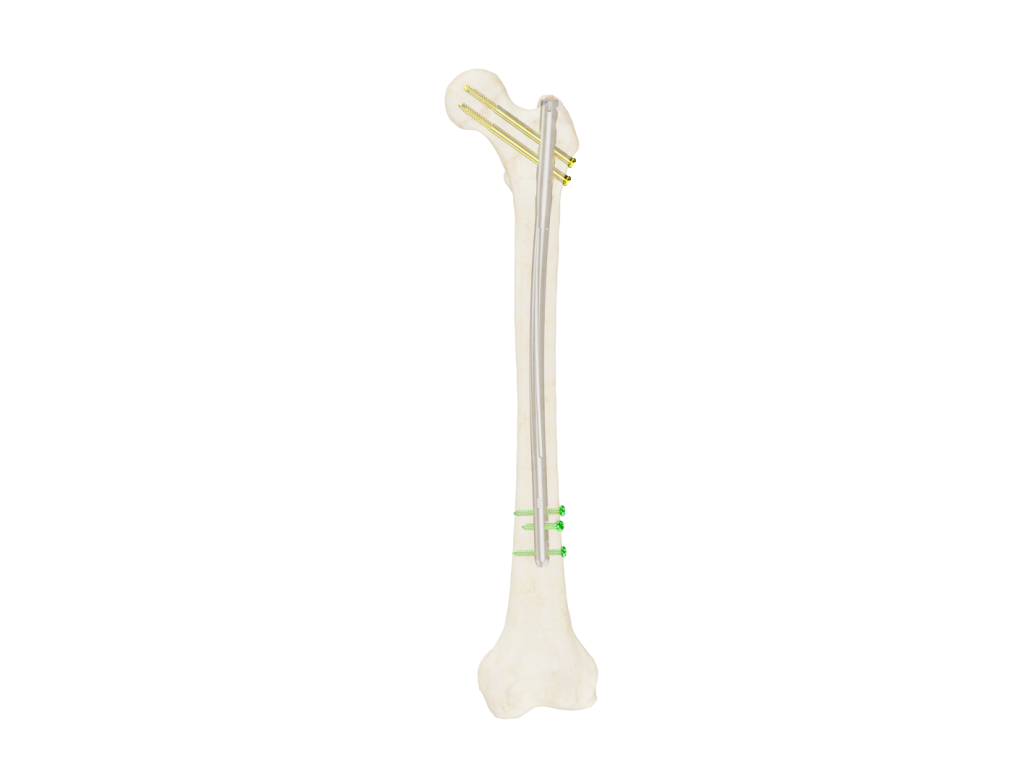 Clavo Support Reconstrucción Femoral – App Pedidos Sampedro