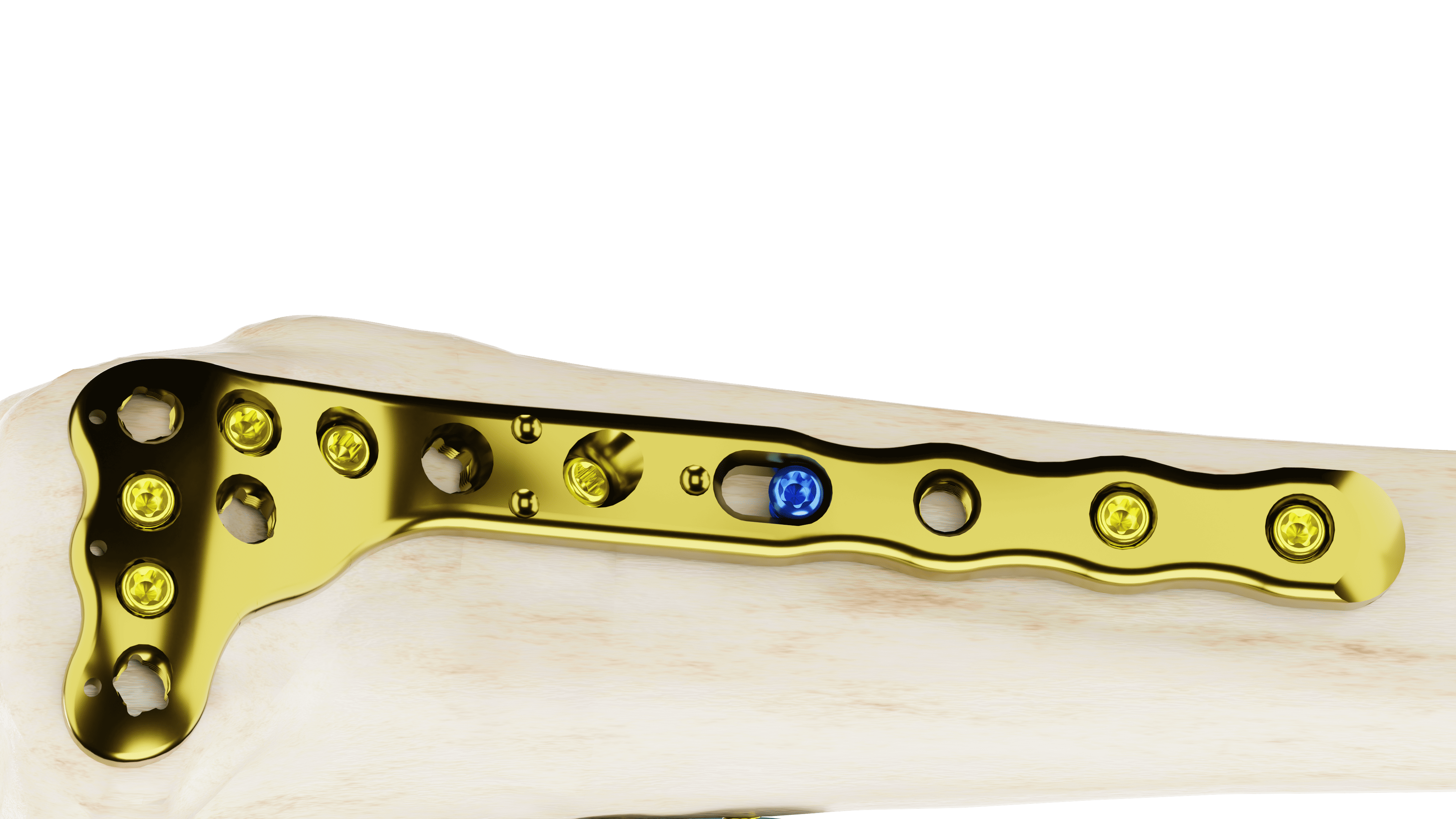 Affinity Tibia Proximal – App Pedidos Sampedro
