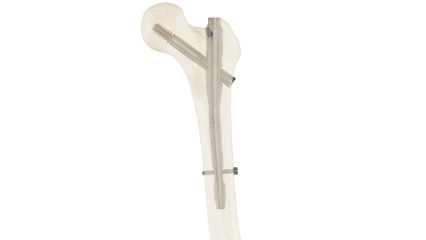Clavo Support Fémur Proximal – App Pedidos Sampedro